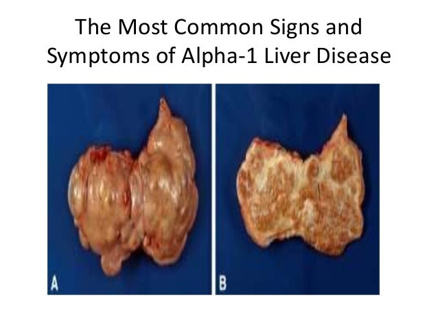 Alpha 1 antitrypsin deficiency