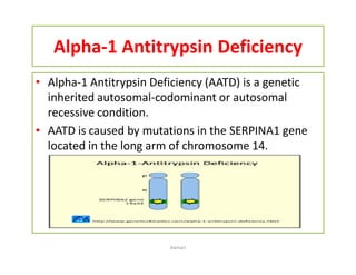 Alpha 1 antitrypsin deficiency: Jimcale M Xamari | PPT