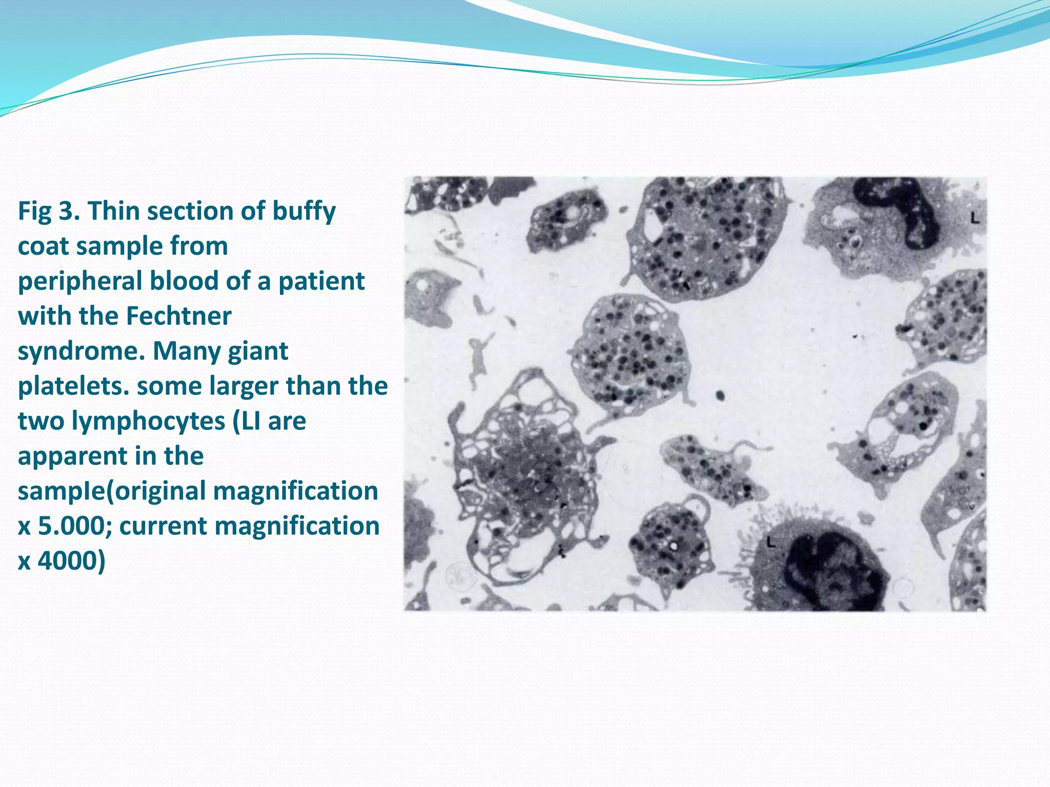 Alport syndrome. group 7 | PPTX