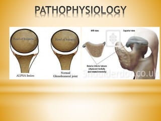 Alpsa lesion | PPTX