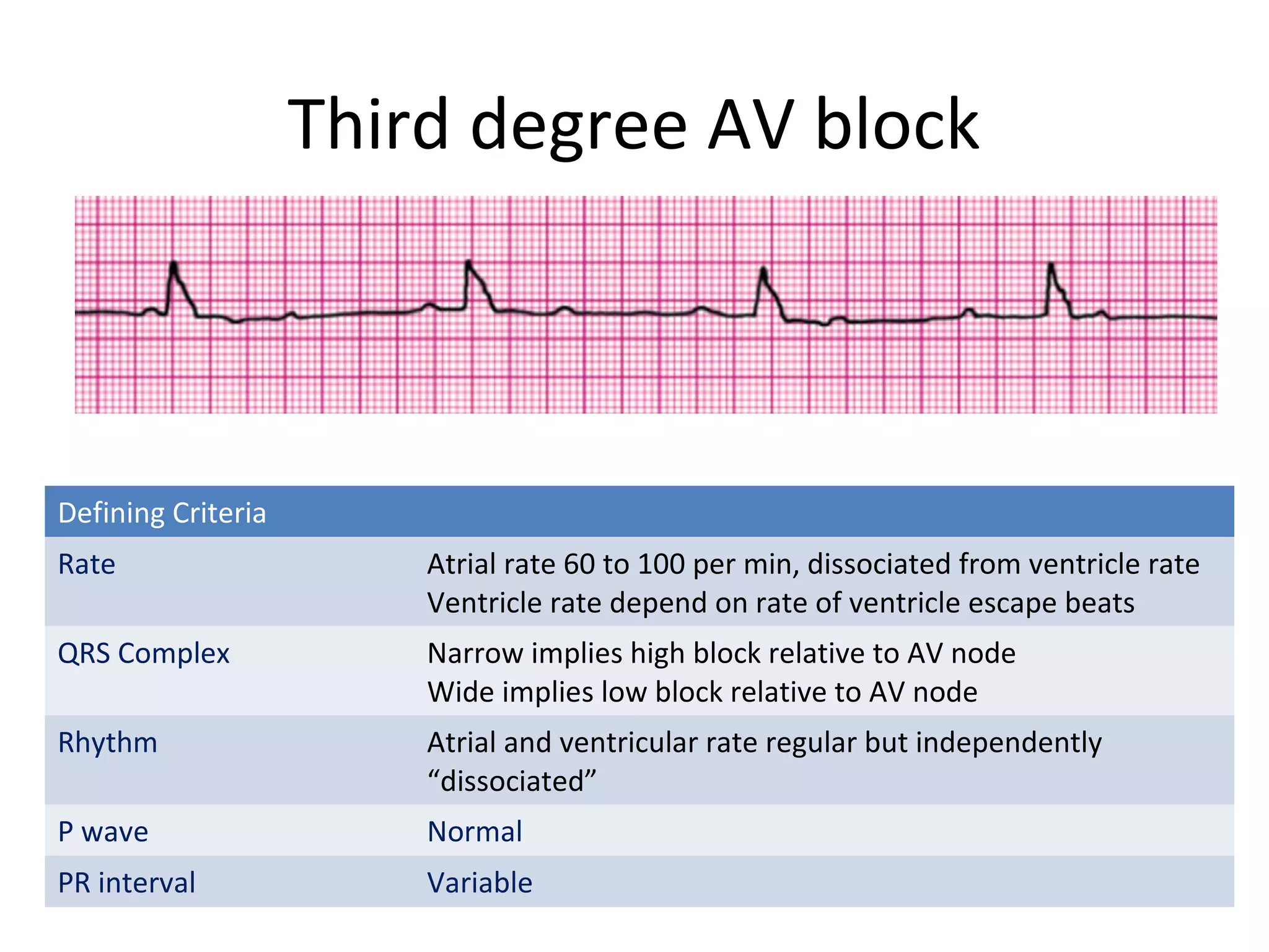 Als core ecg rhythm by dr vijaykumar silvaraja | PPT
