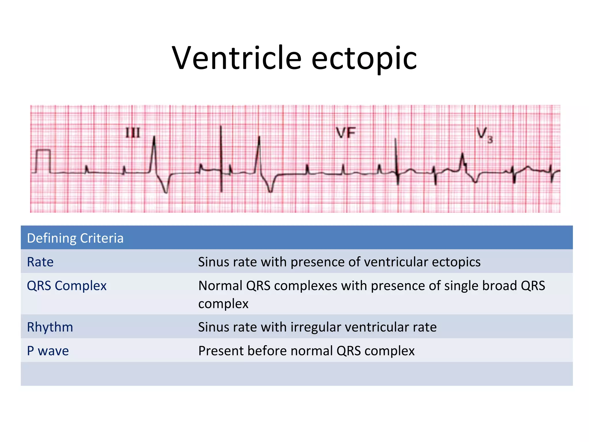 Als core ecg rhythm by dr vijaykumar silvaraja | PPT