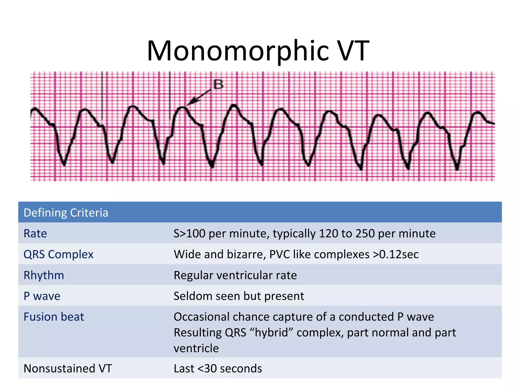 Als core ecg rhythm by dr vijaykumar silvaraja | PPT