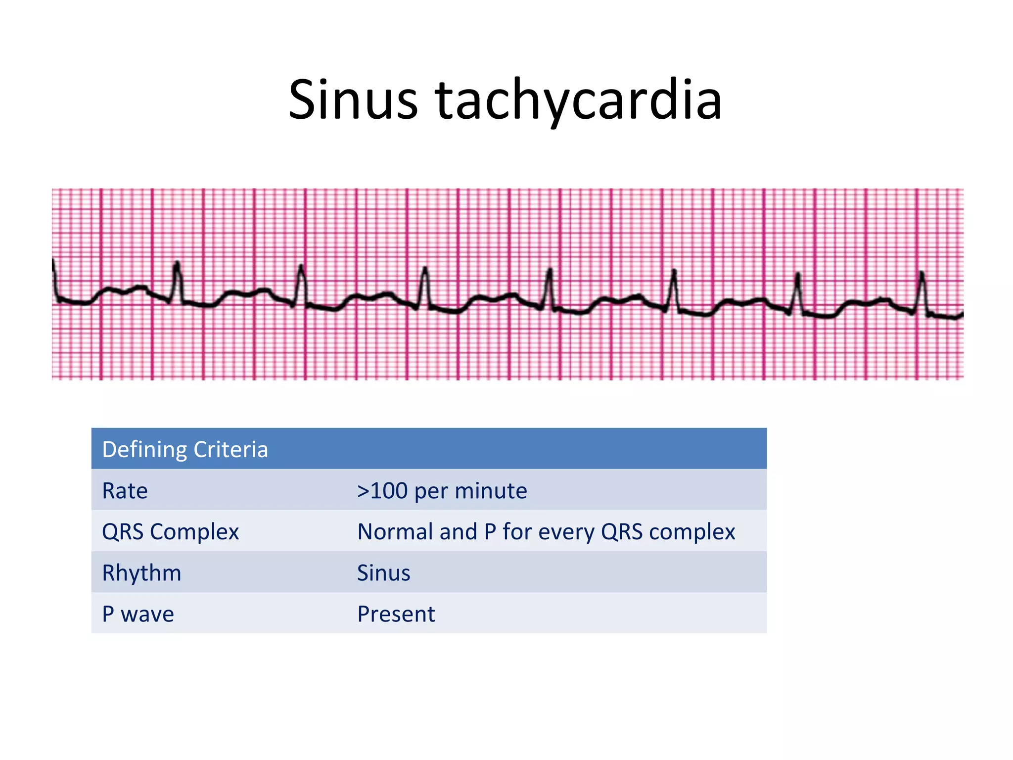 Als core ecg rhythm by dr vijaykumar silvaraja | PPT