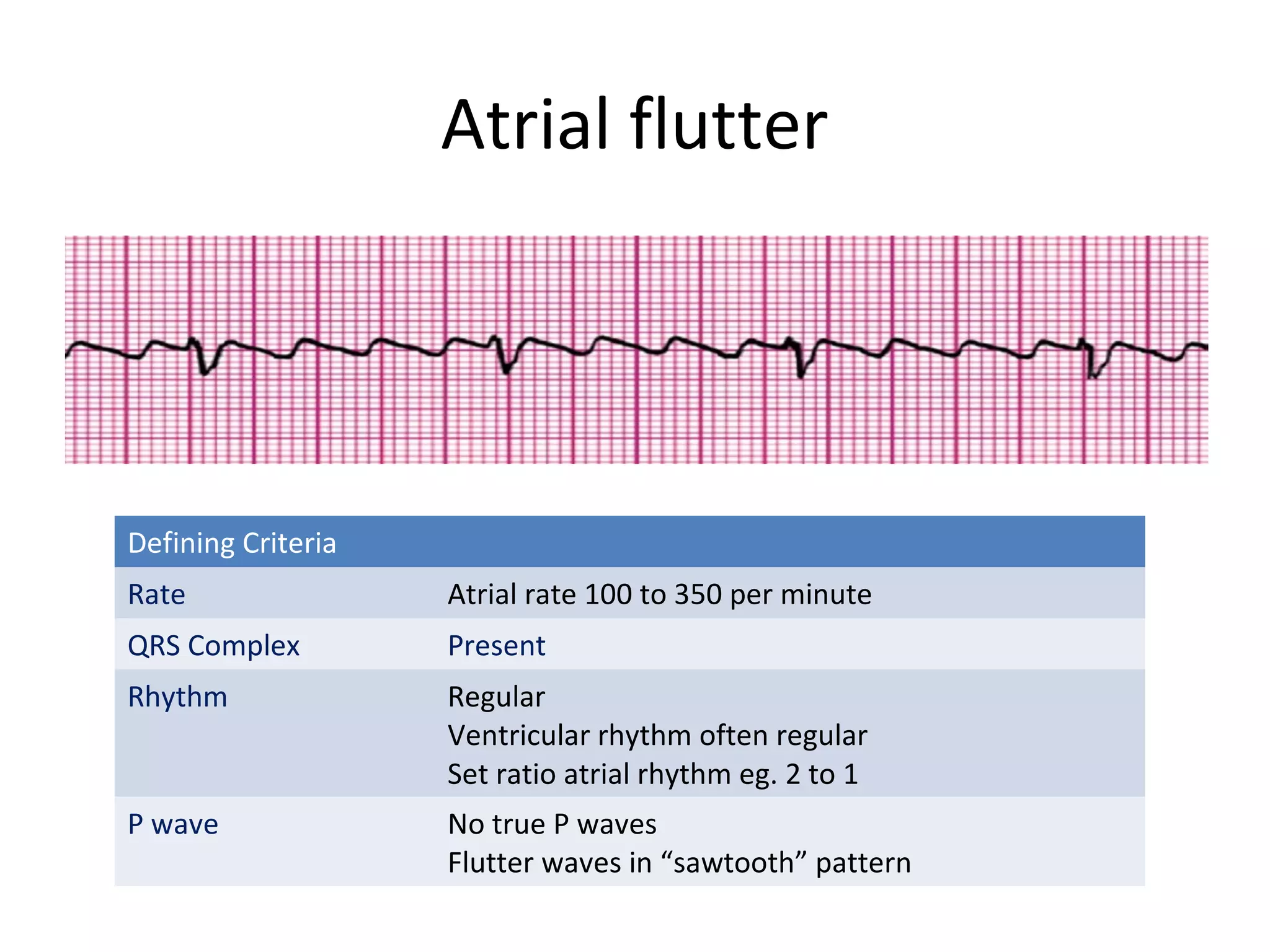 Als core ecg rhythm by dr vijaykumar silvaraja | PPT