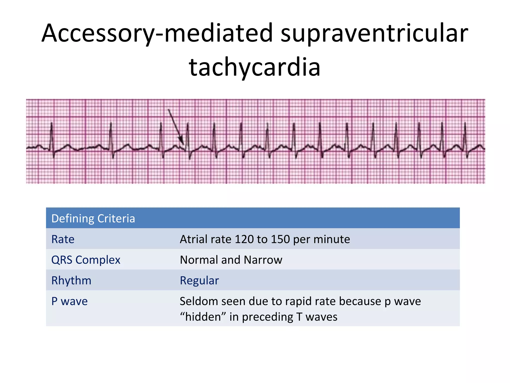 Als core ecg rhythm by dr vijaykumar silvaraja | PPT