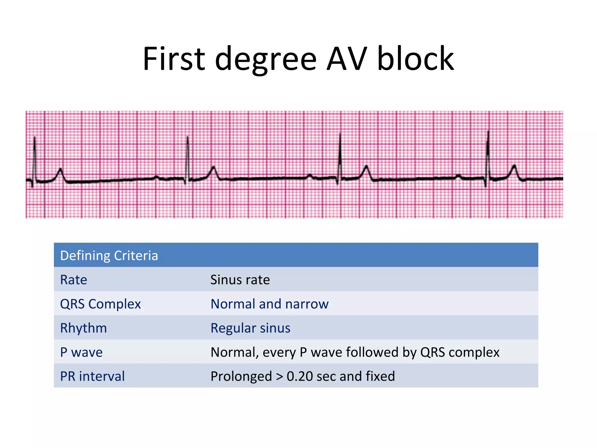 Als core ecg rhythm by dr vijaykumar silvaraja | PPT