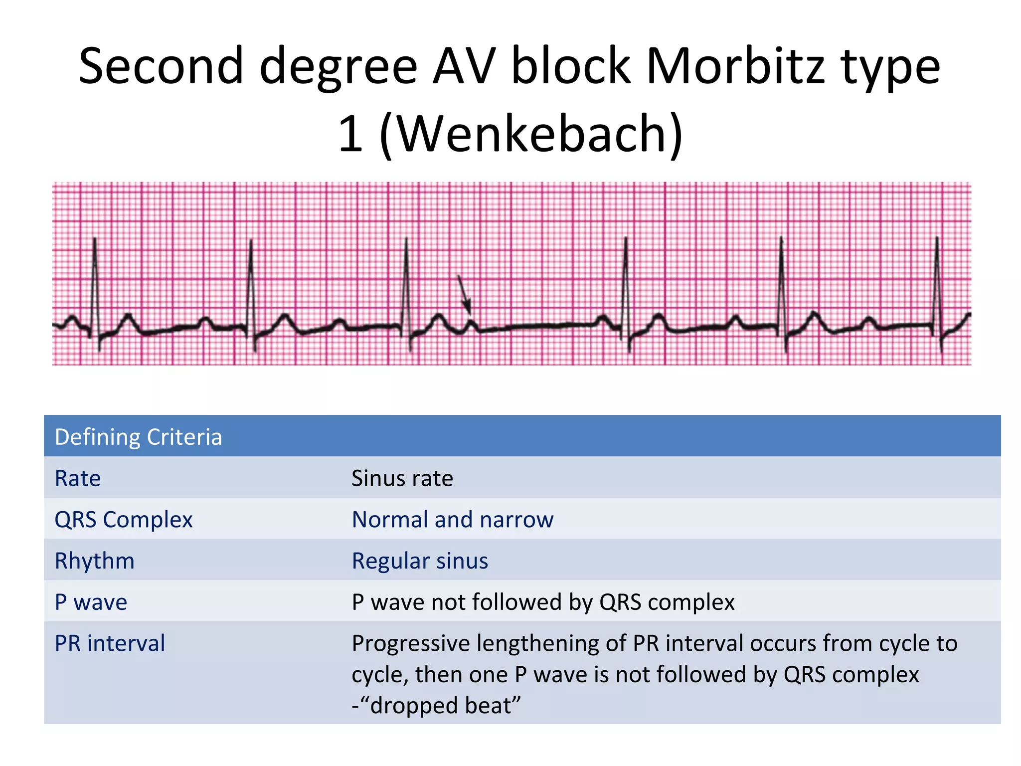 Als core ecg rhythm by dr vijaykumar silvaraja | PPT