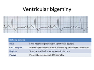 Als core ecg rhythm by dr vijaykumar silvaraja | PPT