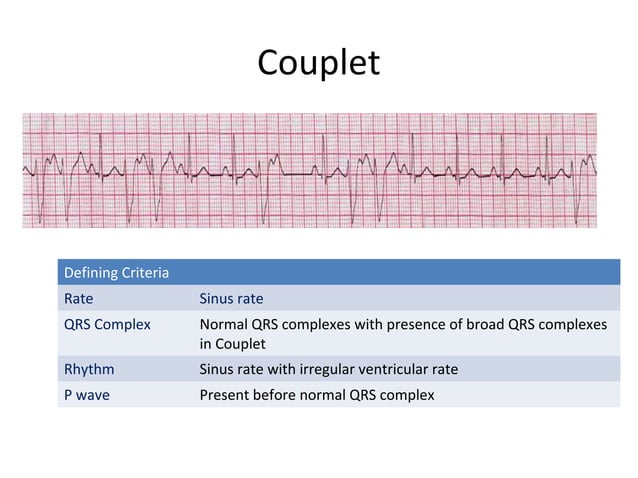 Als core ecg rhythm by dr vijaykumar silvaraja | PPT