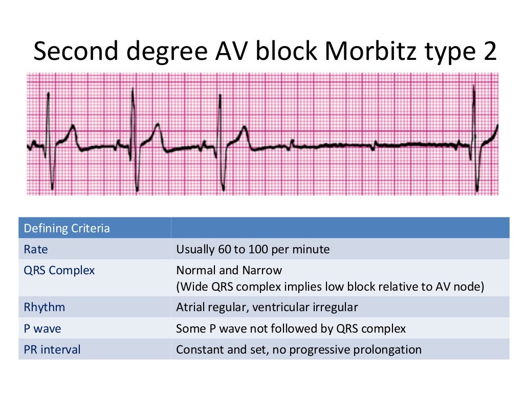 Als core ecg rhythm by dr vijaykumar silvaraja