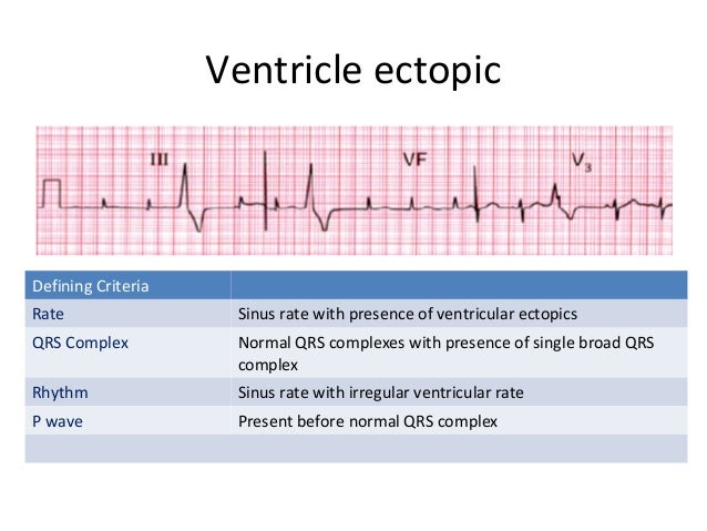 Als core ecg rhythm by dr vijaykumar silvaraja