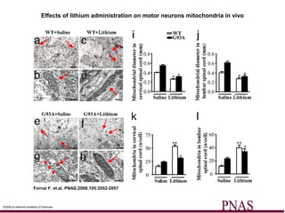 lithium in treatment of motor neuron disease | PPT