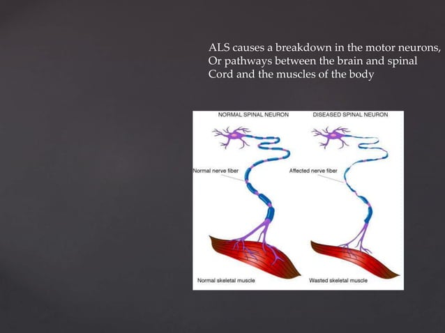 Als presentation | PPTX | Physical Therapy | Wellness