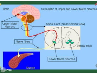 Amyotrophic lateral sclerosis (ALS) | PPT