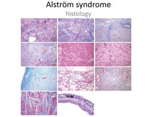 Alström syndrome | PPTX