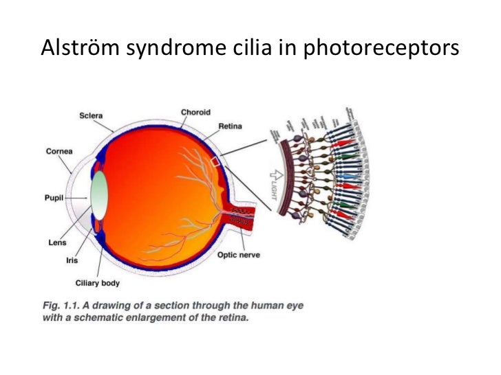 Alström syndrome