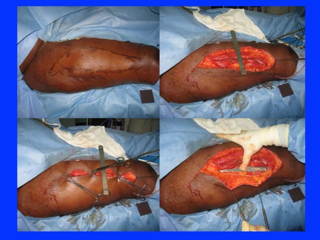 ALT flap donor defect closure.pptx