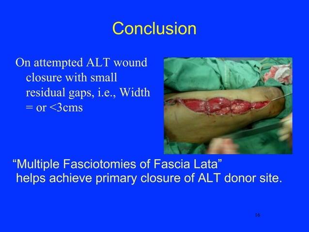 ALT flap donor defect closure.pptx
