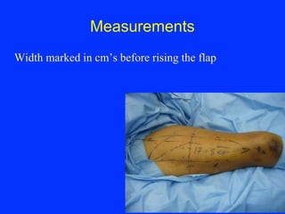 ALT flap donor defect closure.pptx