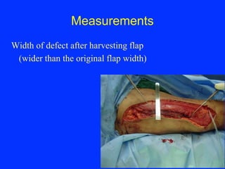 ALT flap donor defect closure.pptx
