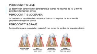 Alteraciones periodontales | PPTX