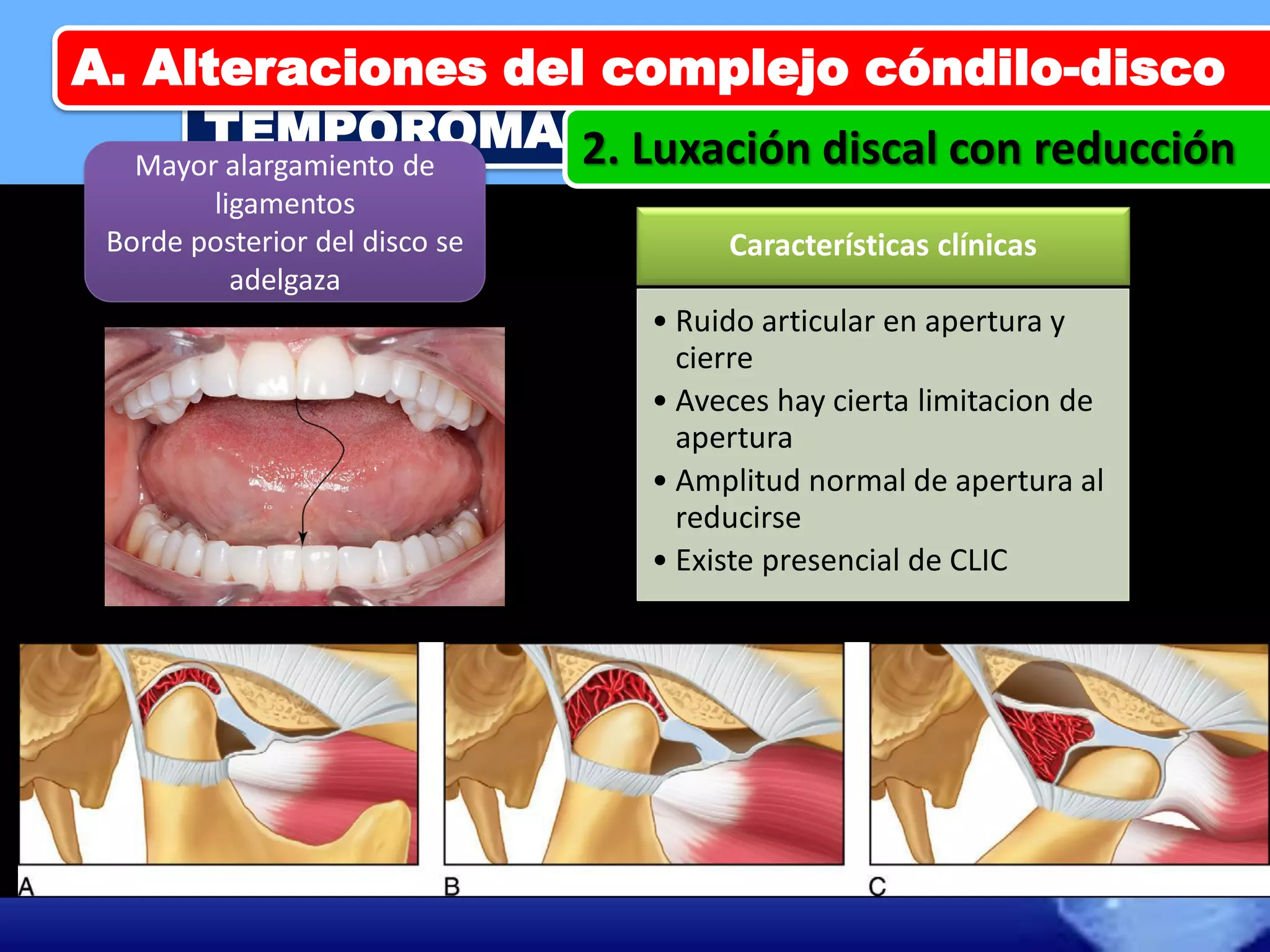 Alteraciones de la articulacion temporomandibular ATM | PDF