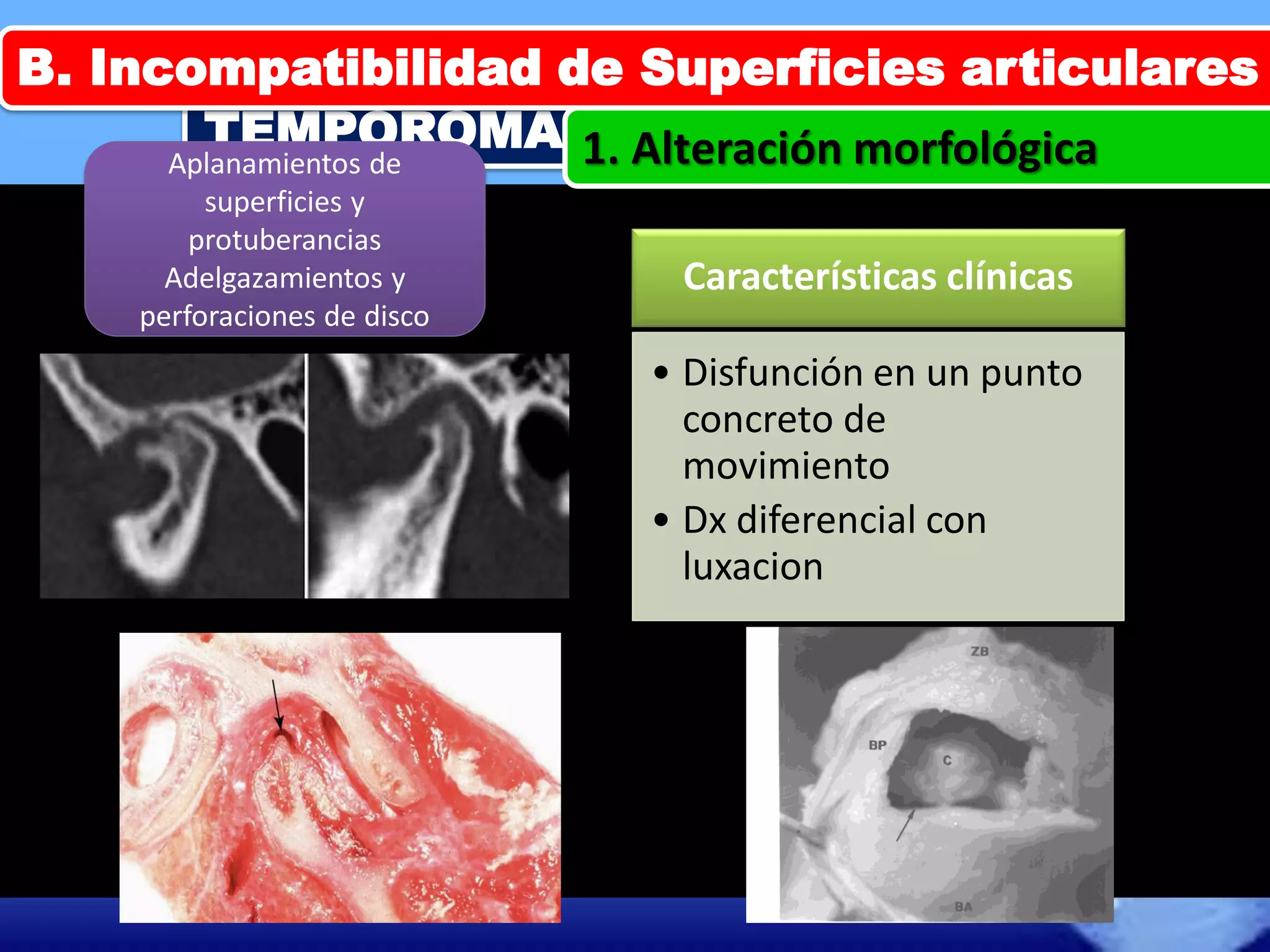 Alteraciones de la articulacion temporomandibular ATM | PDF