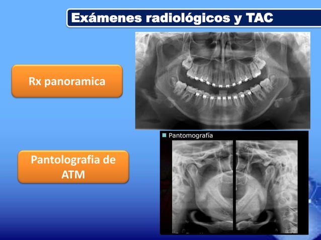 Alteraciones de la articulacion temporomandibular ATM | PPT