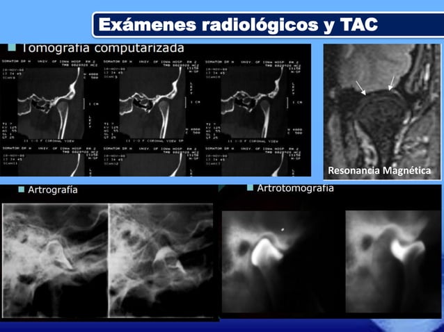Alteraciones de la articulacion temporomandibular ATM | PDF