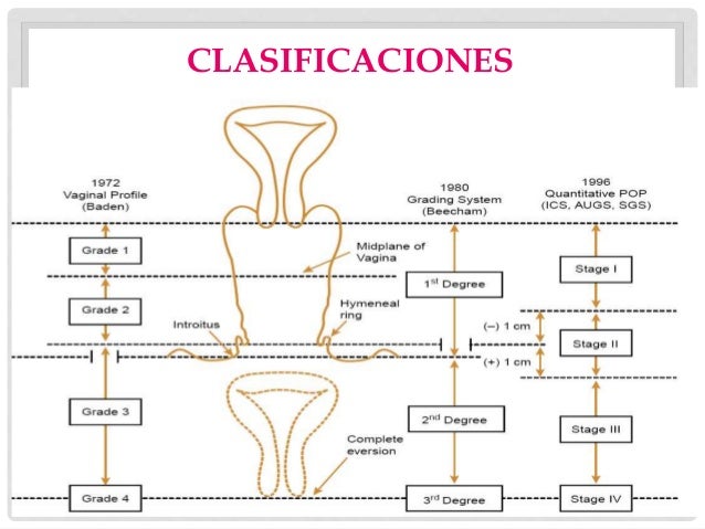 Prolapso uterino-Pichardo