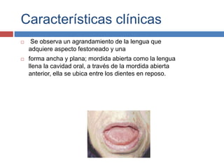 Alteraciones del desarrollo de la lengua | PPTX