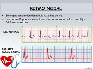 Alteraciones del ECG | PPT