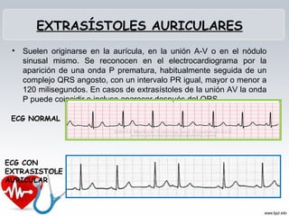Alteraciones del ECG | PPT