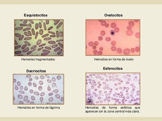 Alteraciones de los elementos formes sanguíneos