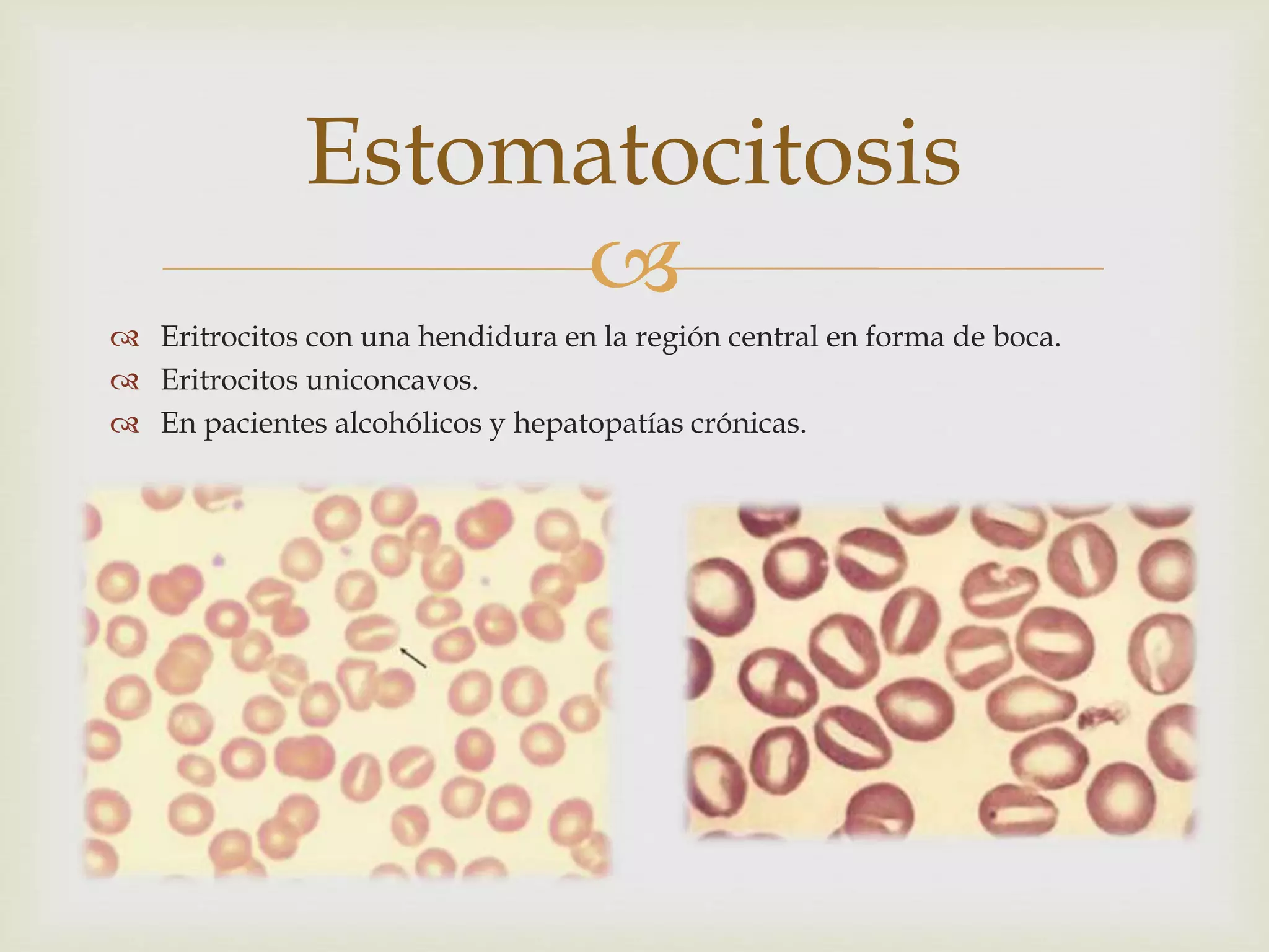 Alteraciones de los eritrocitos | PPTX | Blood Disorders | Diseases and ...