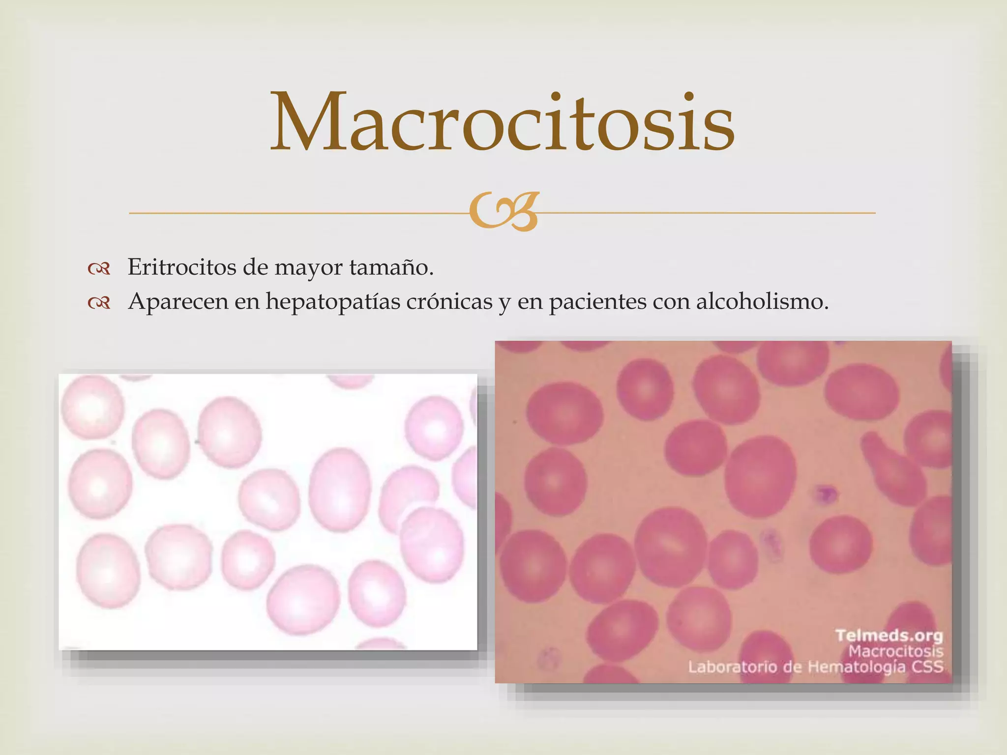 Alteraciones de los eritrocitos | PPTX | Blood Disorders | Diseases and ...