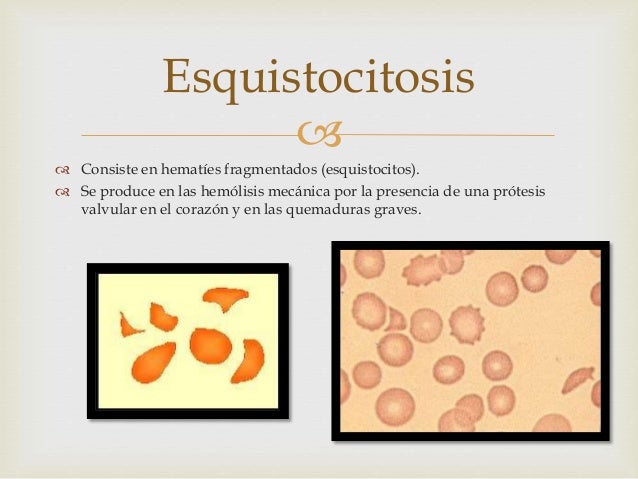 Alteraciones de los eritrocitos