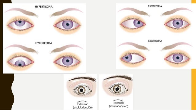 Alteraciones de los movimiento oculares