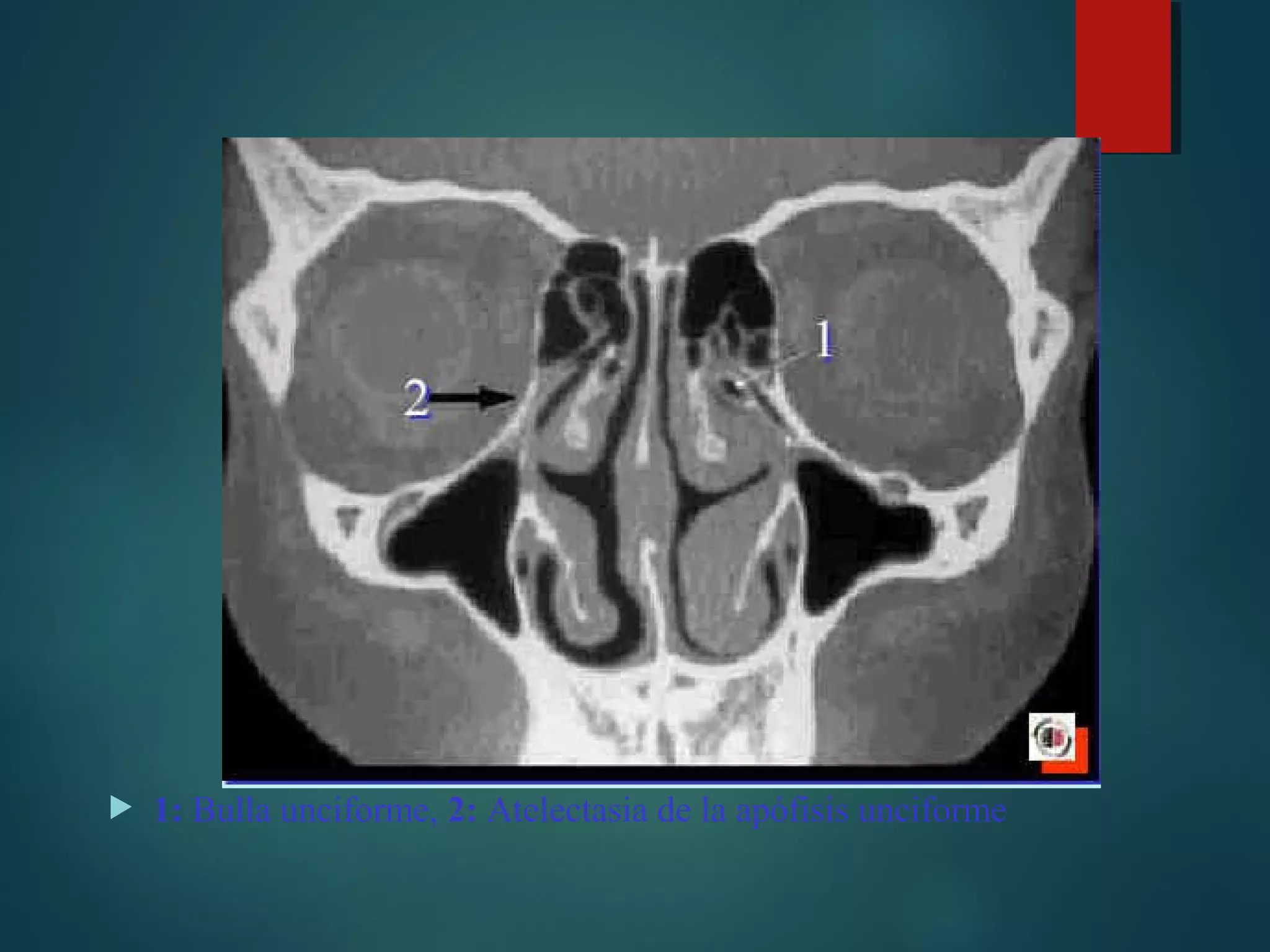 SENOS PARANASALES VARIANTES ANATOMICAS | PPT