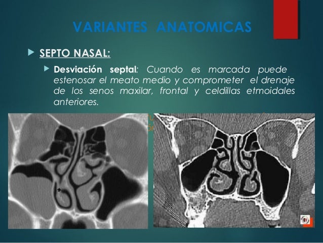 SENOS PARANASALES VARIANTES ANATOMICAS