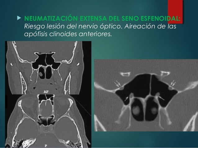 SENOS PARANASALES VARIANTES ANATOMICAS