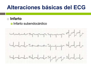 Alteraciones en el electrocardiograma. Infarto, Hipertrofia ...