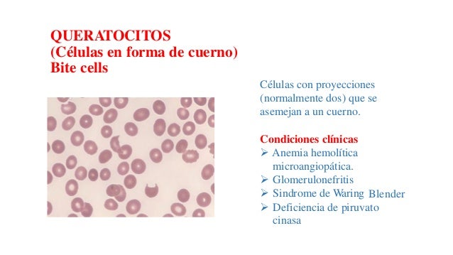 Alteraciones eritrocitarias