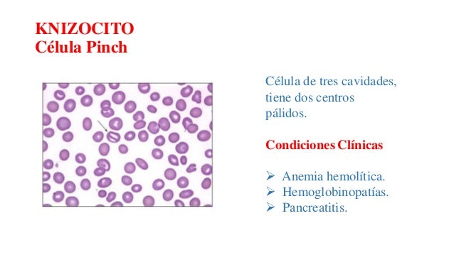 Alteraciones eritrocitarias