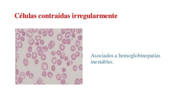Alteraciones eritrocitarias