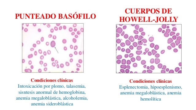 Alteraciones eritrocitarias