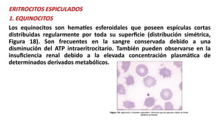 ALTERACIONES MORFOLOGICAS DE LOS ERITROCITOS II.pptx