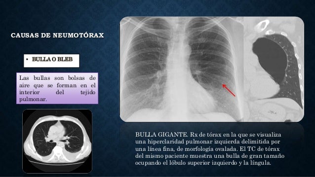 Alteraciones parenquimatosas (HIPERCLARIDAD PULMONAR)