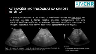 Alterações da morfologia hepática na cirrose.pdf